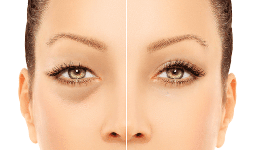 Comment se débarrasser des poches ou les cercles sous les yeux