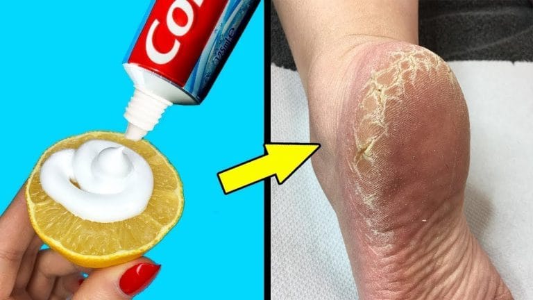 5 Astuces naturelles pour soigner des pieds craquelés - Sante Peau Noir