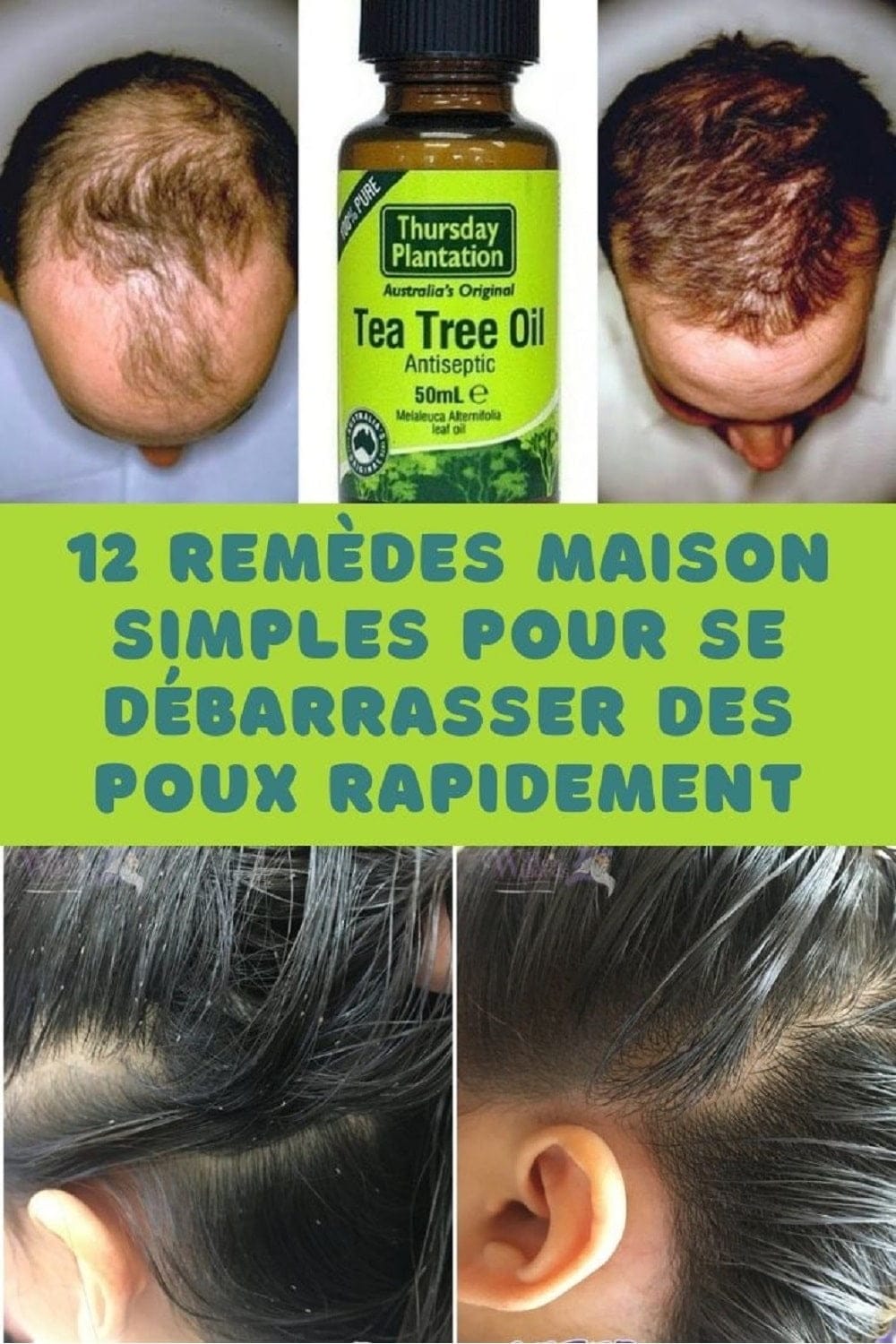 12 remèdes maison simples pour se débarrasser des poux rapidement ...