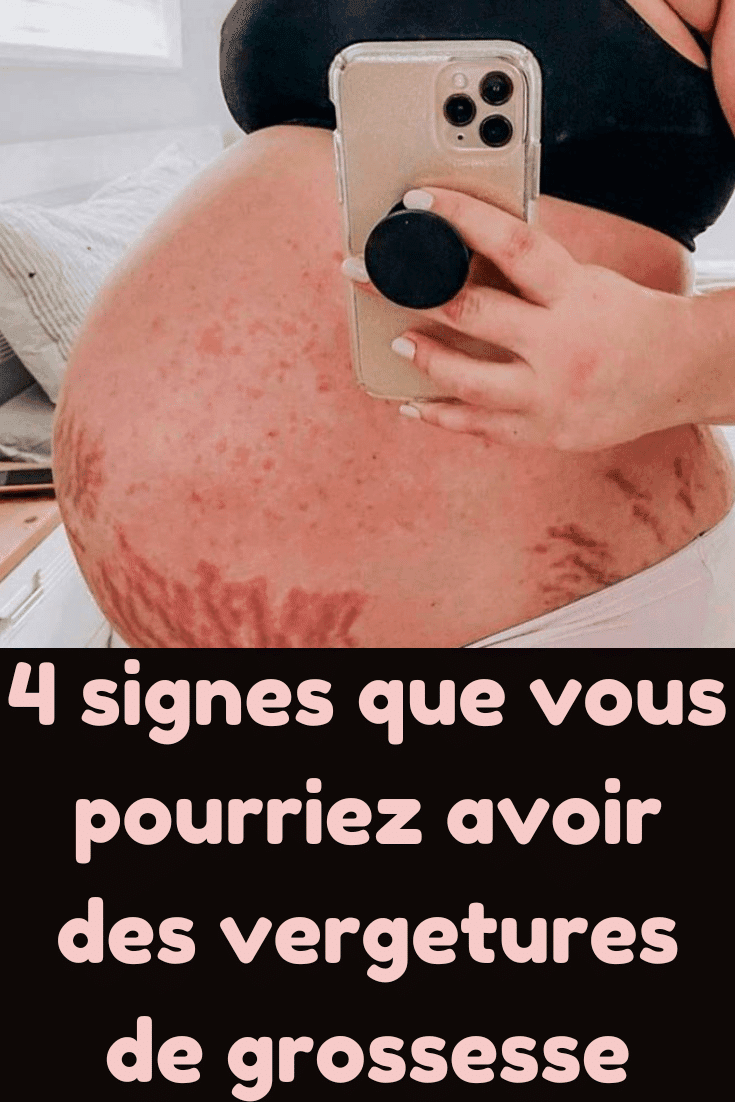 4 signes que vous pourriez avoir des vergetures pendant la grossesse